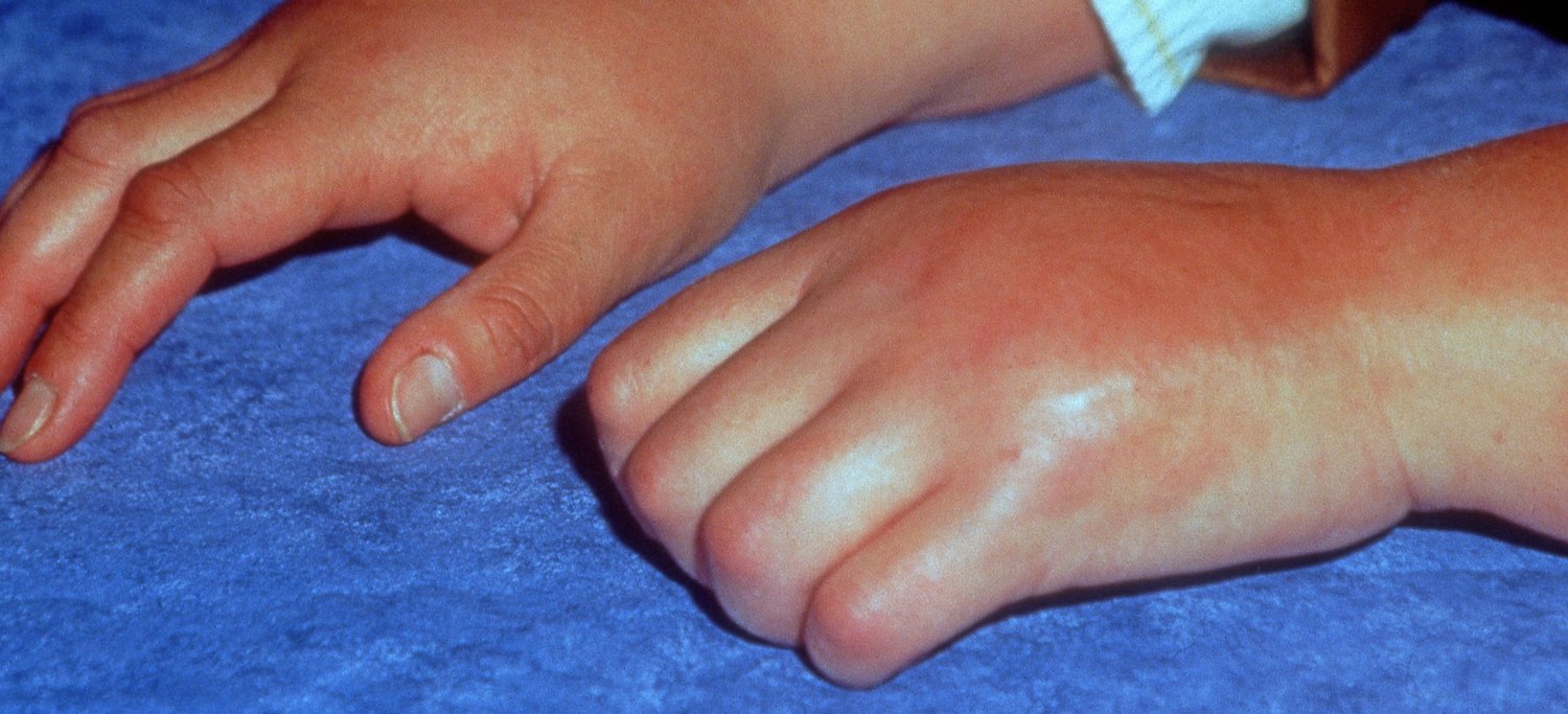 Understanding Complex Regional Pain Syndrome (CRPS) Understanding Complex Regional Pain Syndrome (CRPS)